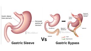 Gastric Sleeve vs Gastric Bypass: 10-Year Weight Loss