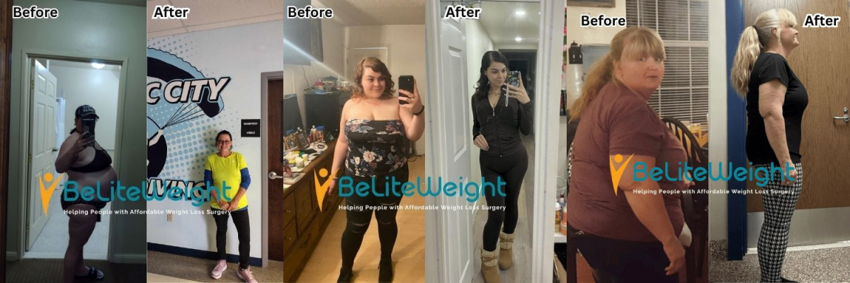 Weight Loss Surgery in Mexico - BeLiteWeight